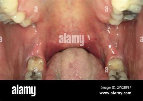Swollen Mouth Uvula Palate Stock Videos And Footage Hd And 4k Video