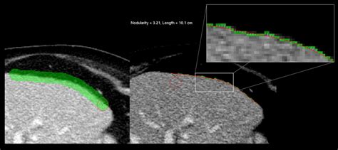 Measurement Of Liver Surface Nodularity Lsn In A Patient With