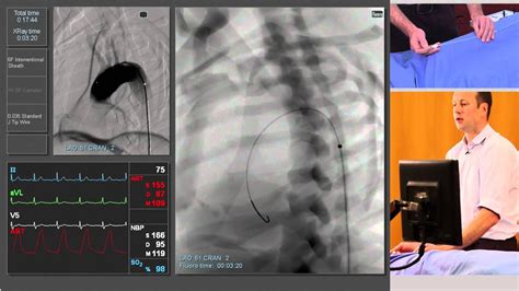 Arch Aortography Youtube