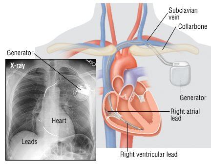 Pacemaker Guide