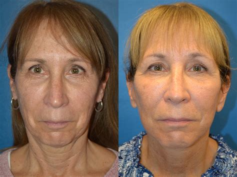Rhytidectomy Before And After Dr George Miguel
