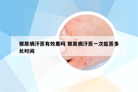 银屑病汗蒸有效果吗 银屑病汗蒸一次能蒸多长时间 新锐皮肤百科网