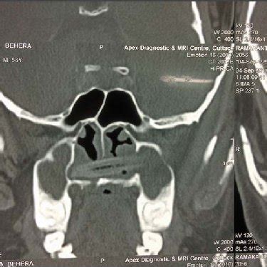 Ct Scan Showing Foreign Body In Maxillary Sinus And Infratemporal Fossa