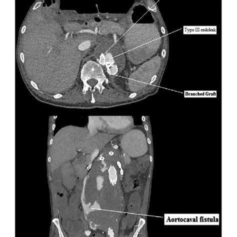 Follow Up Computed Tomography Scan Of The Aorta At 1 Month Shows