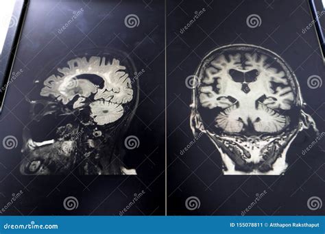 Brain Atrophy For Education And Diagnostic Stock Image Image Of Cerebral Alzheimer 155078811