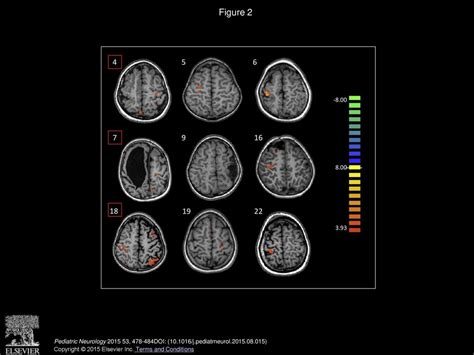 Functional Mapping In Pediatric Epilepsy Surgical Candidates Functional Magnetic Resonance