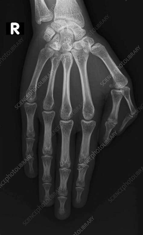 Hand Polydactyly X Ray Stock Image F0365317 Science Photo Library