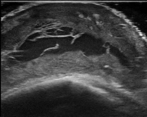 Musculoskeletal Joints And Tendons 62 Elbow Case 625 Olecranon