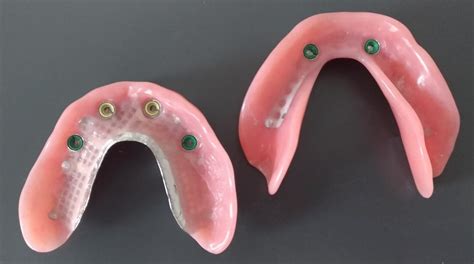 Locator Implant Retained Dentures Burnham Denture Clinic In Edmonton