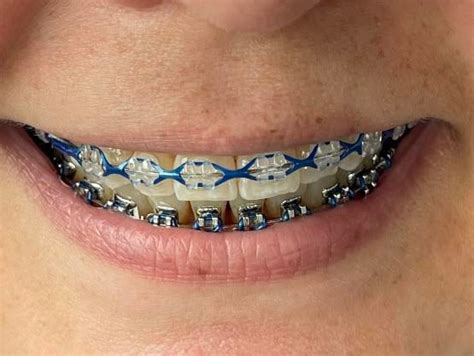 Cute Braces Colors Combinations For Girls