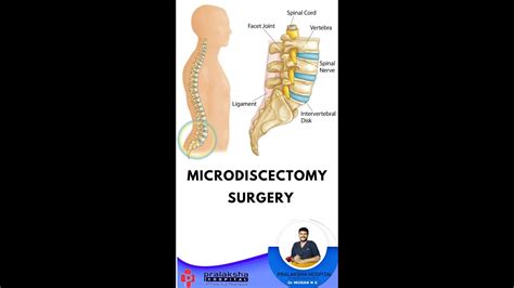 Microdiscectomyl4 L5 Surgery Intervertebral Disk Prolapse Dr Mohan