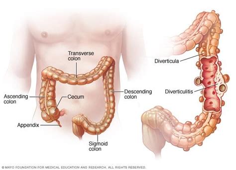 Diverticulitis Sacs In Colon Word Of Health