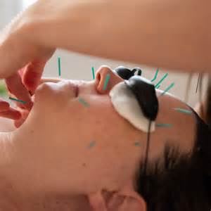 Can Cosmetic Acupuncture Be The New Botox The New York Times