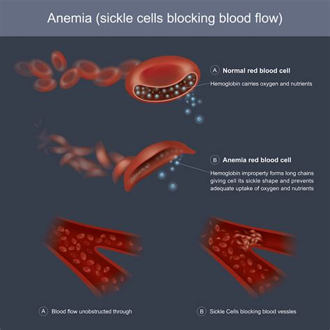 Sickle Cell Crisis A Real Life Rollercoaster Umedoc Telehealth Platform