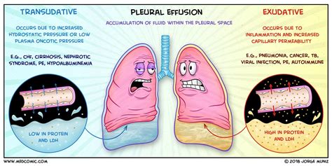 Pleural Effusions Transudate Vs Exudate Medcomic