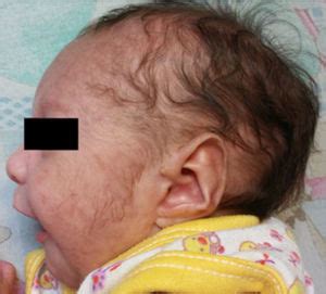 Cromosoma 13 En Anillo Reporte De Caso Pediatría