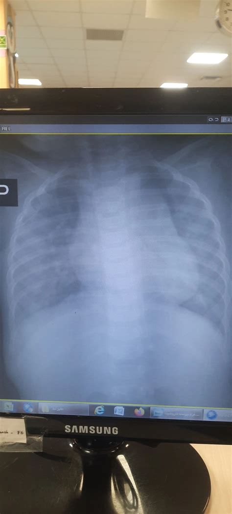 Abdolhamid Taghizadeh On Linkedin A 7 Month Old Infant A Case Of Vsd Ventricular Septal