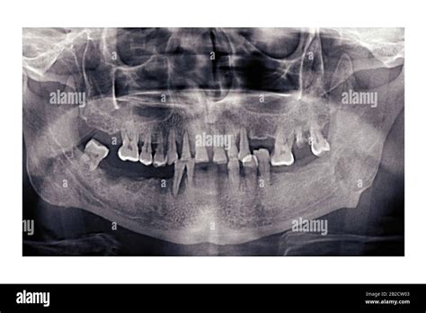 X Ray Of Bad Teeth