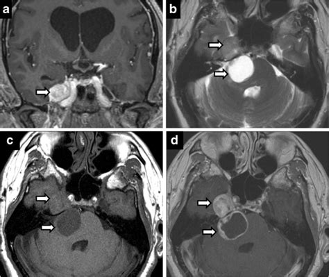 Neuroimaging Of Meckels Cave In Normal And Disease Conditions Pmc