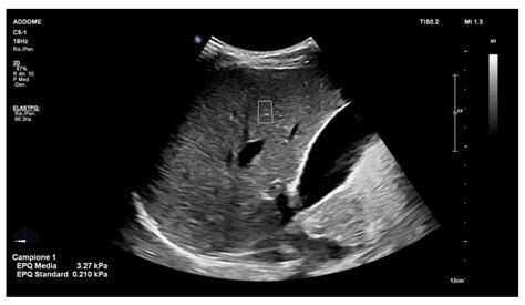 Liver Ultrasound Elastography In Non Alcoholic Fatty Liver Disease A