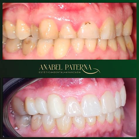 Inyectado Digital En La Clínica Anabel Paterna