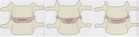 Diagram Of Age Related To Cervical Intervertebral Disc Quizlet