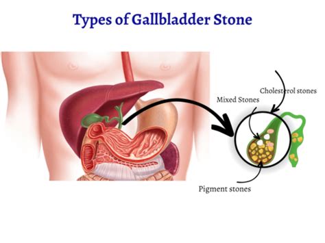 Homeopathic Treatment For Gallbladder Stones Dr Deepika