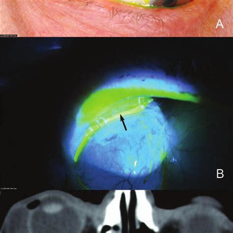 Pdf Marsupialization For Lacrimal Ductular Cysts Dacryops A Case