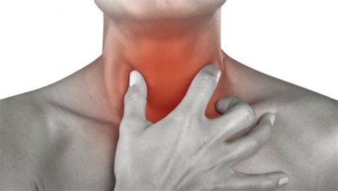 Esofagitis Complicaciones Síntomas Y Tipos