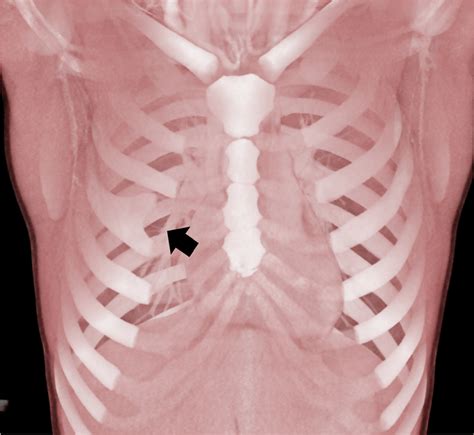 Bifid Ribs Volume Rendered Anteroposterior Three Dimensional