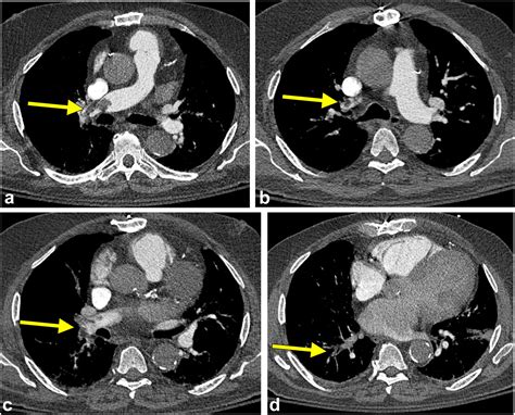 The Predictive Value Of Qanadli And Miller Index Scores In Patients