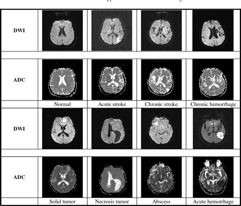 table 2 from review of brain lesion detection and classification using neuroimaging analysis