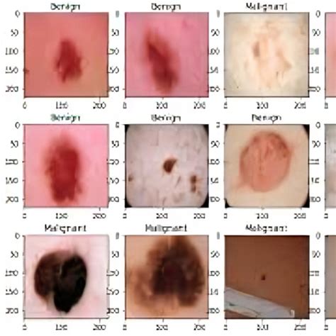 Skin Cancer Detection Kaggle Skin Cancer Detection Kaggle