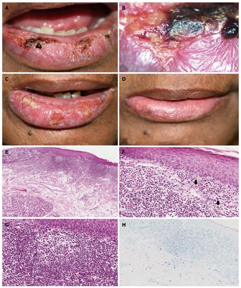 Plasma Cell Cheilitis