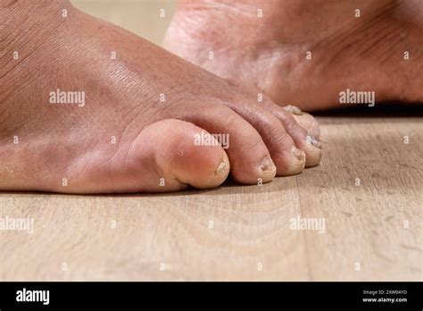 Cancer Chemotherapy Cause Skin To Become Dry Dark Or Peel And Nails