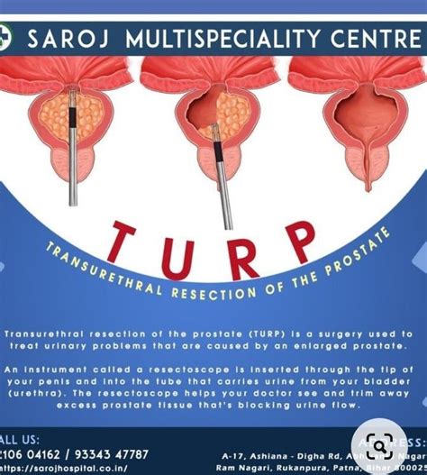 Pin On Turp Prostate Surgery For Men