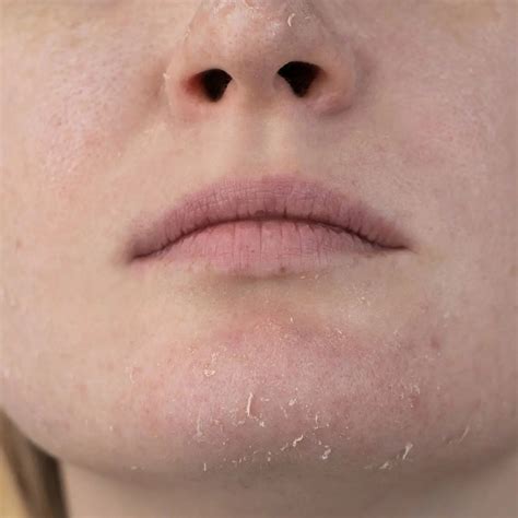 5 Powerful Dry Skin Solutions To Unveil A Flawless Radiant Face Pals
