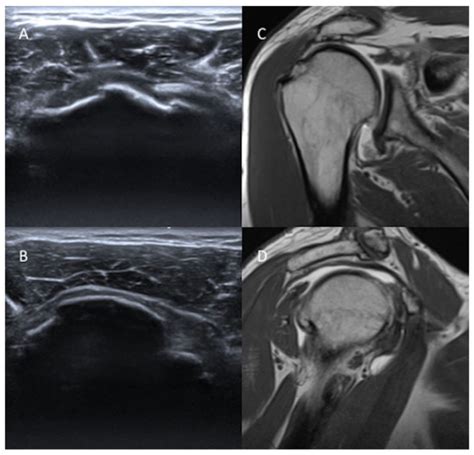 Rotator Cuff Tear Ultrasound Classification At Nickole Williams Blog