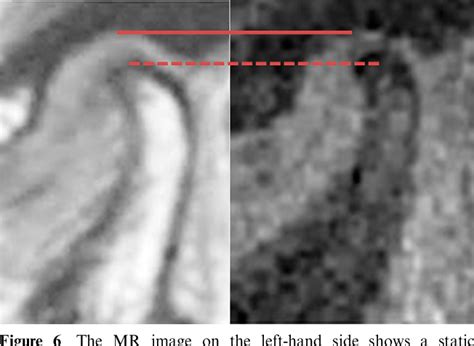 Figure 6 From Dynamic Mri Of The Tmj Under Physical Load Semantic