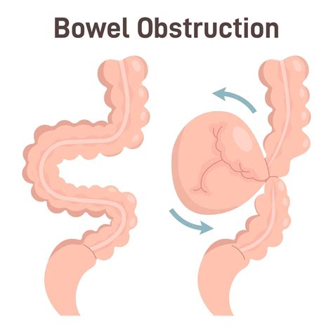 Bowel Obstruction Or Volvulus Loop Of Intestine Twists Around Itself