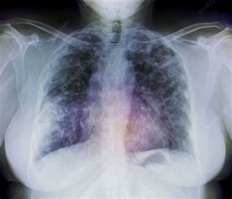Lung Disease Chest X Ray Stock Image C0132195 Science Photo Library
