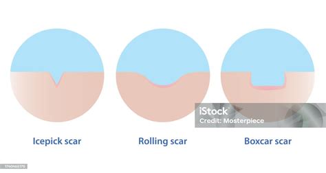 Acne Scars Vector Icon Set Illustration Isolated On White Background