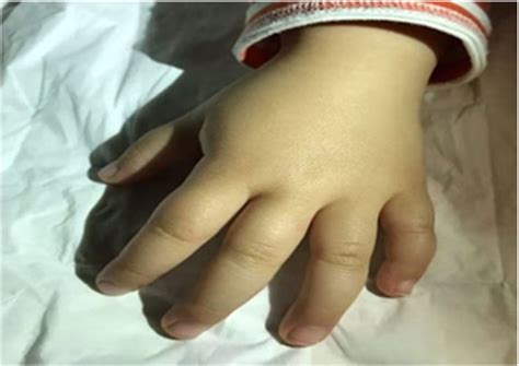 Dysmorphic Features Of Patient Large Fleshy Hands Download