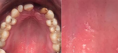A Y B Localización Y Aspecto Clínico De La Lesión Lesión Papular De