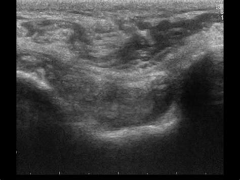 Musculoskeletal Joints And Tendons 62 Elbow Case 628 Distal
