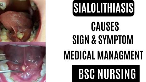 Define Sialolithiasis Clinical Manifestation And Medical Management