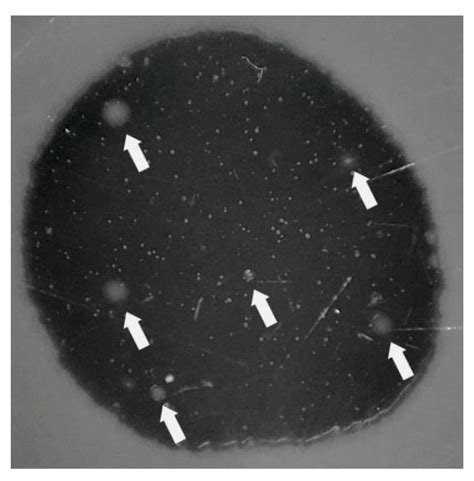 Enterococcus Faecalis Infection