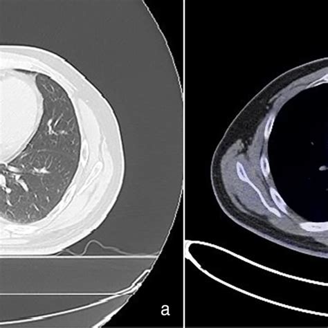 A Computed Tomography Showing A 41 Cm Mass In The Right Middle Lobe