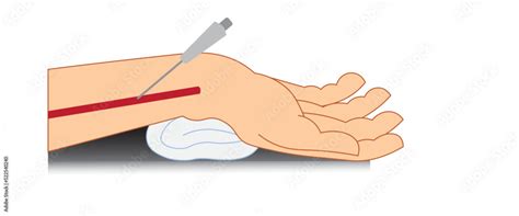 Radial Artery Puncture Illustration Showing Correct Catheter Position