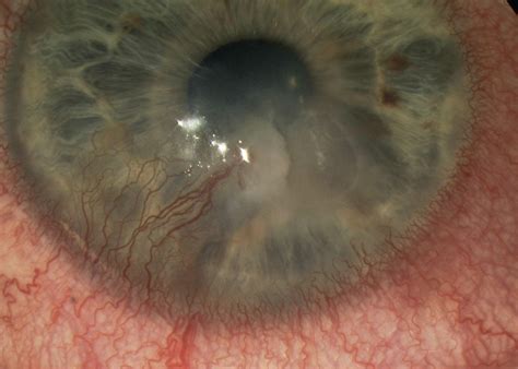 External Eye Disease And The Oculocutaneous Disorders Clinical Tree